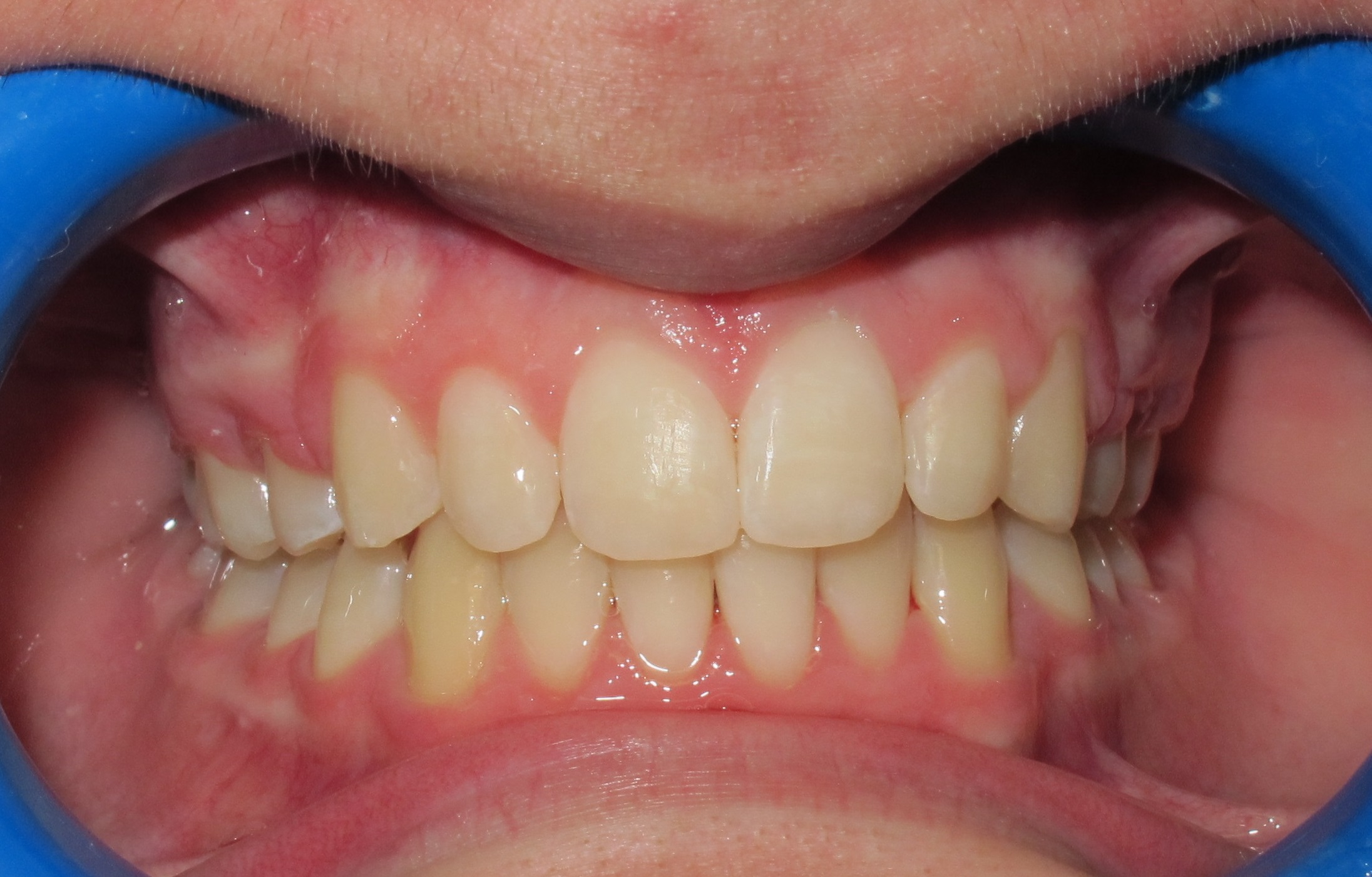 Smile Gallery Khorsand Dental Group | Before & After